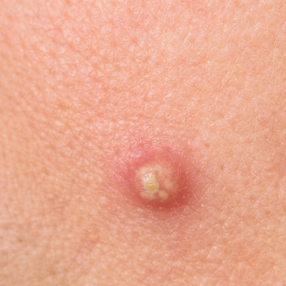 How to Drain Boils Painlessly with Universal Flare Care – MyMagicHealer