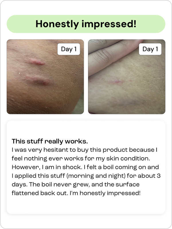 HS, Impetigo, Abscesses & Boils Solution | MyMagicHealer